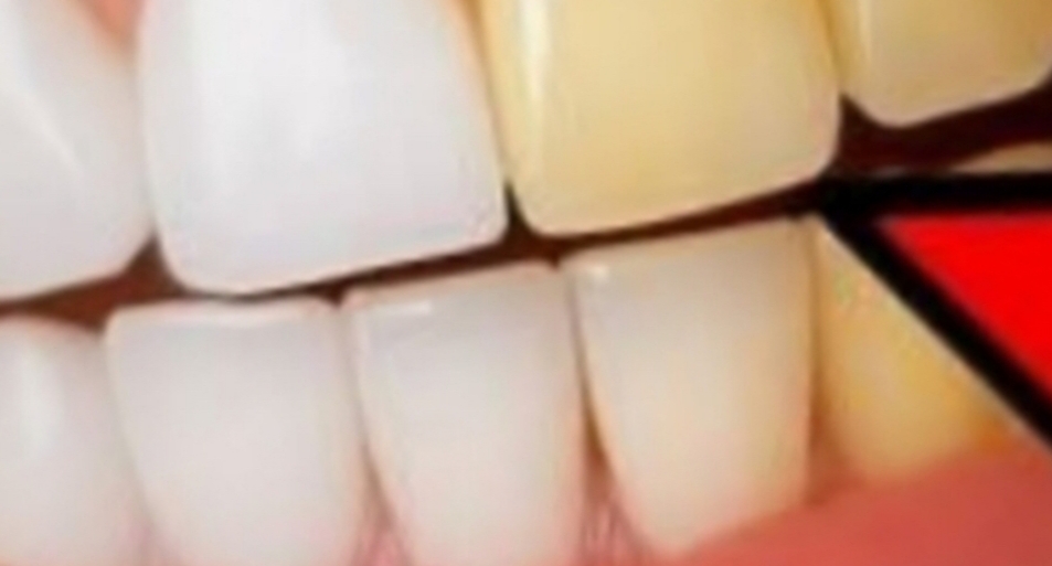 Ginger and salt recipe to whiten teeth and freshen breath naturally ...